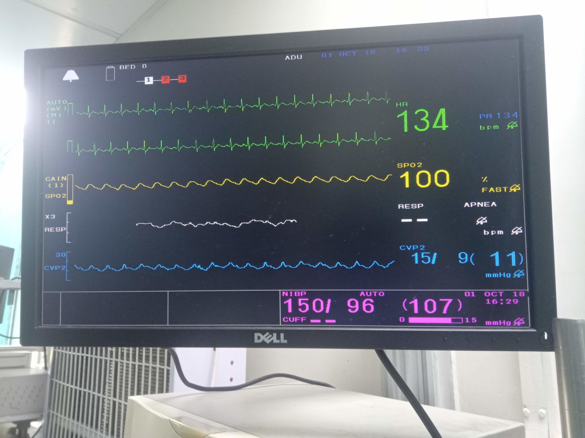 How to use Transducer in Blood Pressure Monitoring - Surgicaltechie.com